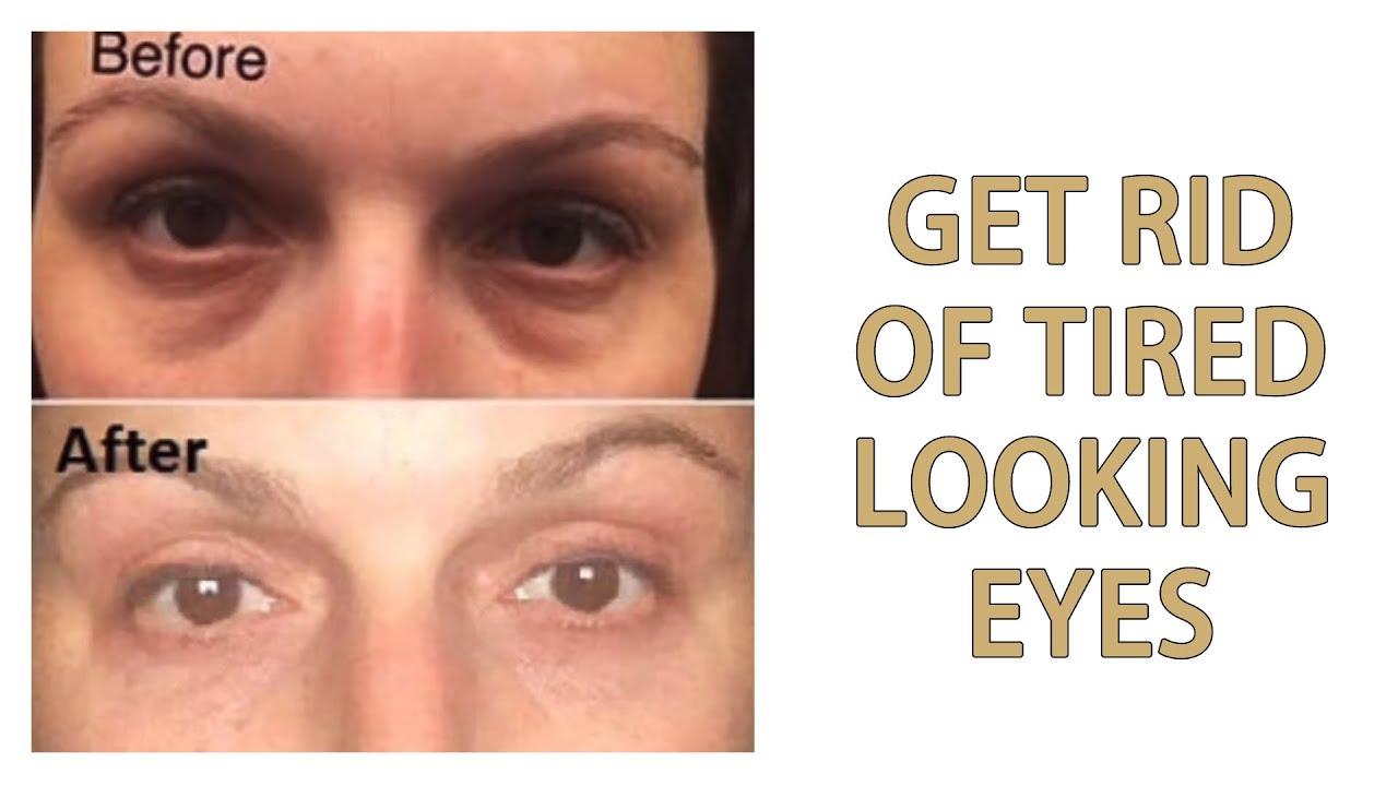 Mom Gets Rid Of Undereye Bags and Droopy Eyes in Korea | Seoul Guide ...