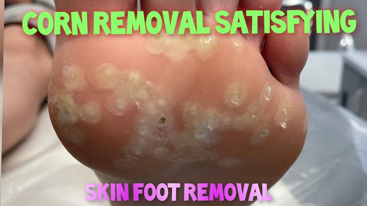 CORN REMOVAL SATISFYING / FOOT SKIN REMOVAL SATISFYING / CARA ...