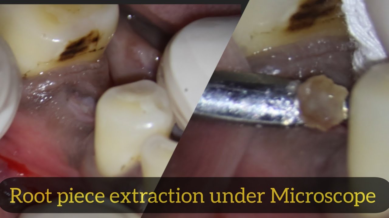 Root Stump Extraction done under Dental Microscope - YouTube