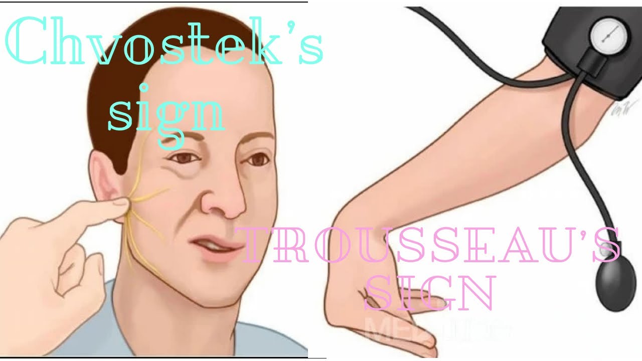 Chvosteks Sign And Trousseaus Sign Youtube