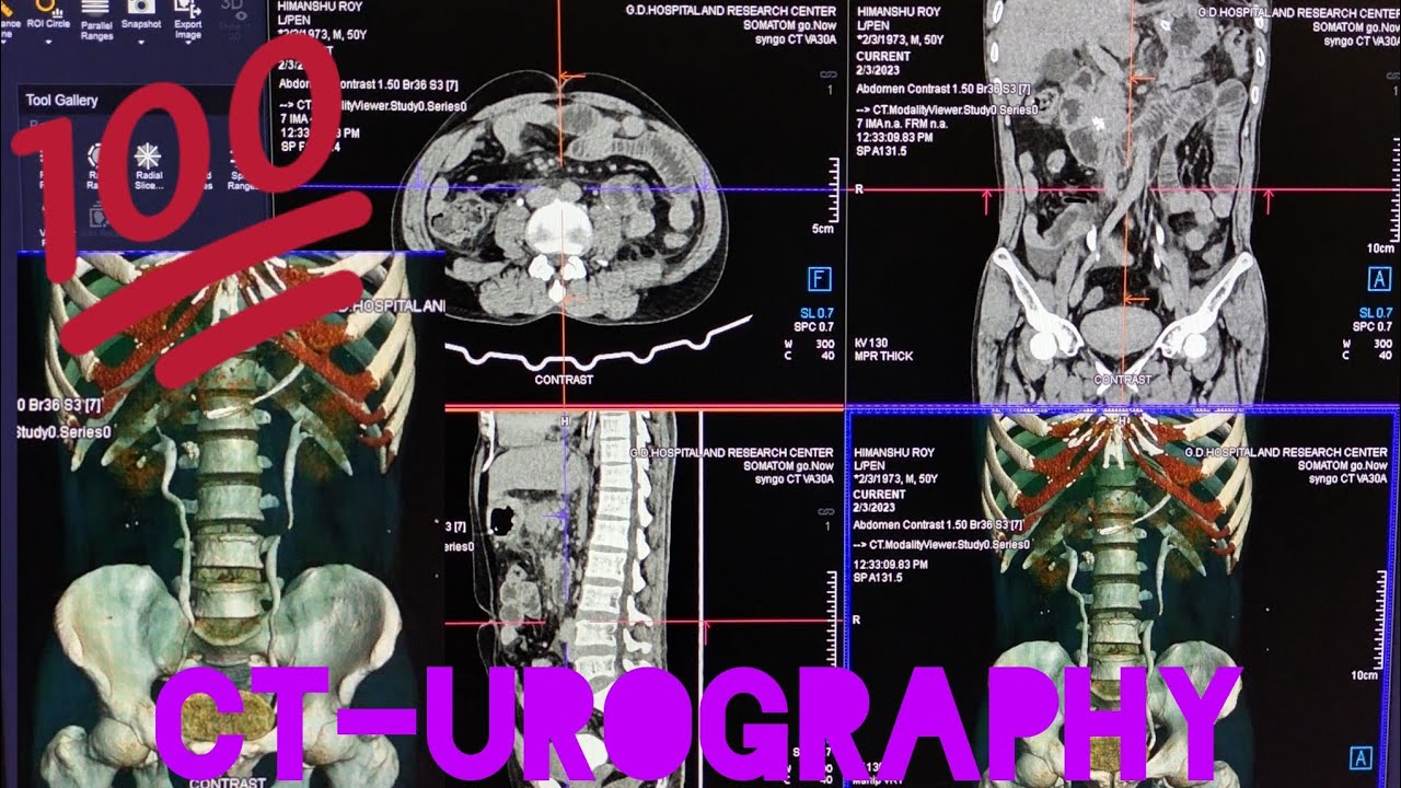 CT SCAN UROGRAPHY,CT URO,Ct uro keise kare,Somatom.go - YouTube