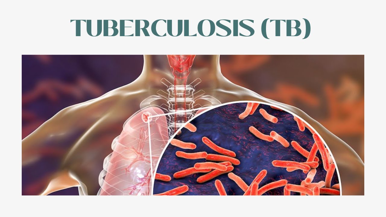 USMLE Respiratory System || Tuberculosis (TB) بالعربي - YouTube