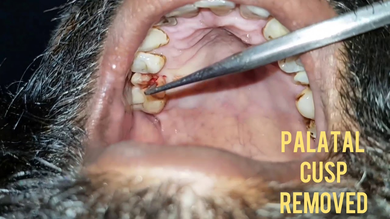 The KEY:- Vertical Fractured Upper Premolar Extraction. - YouTube