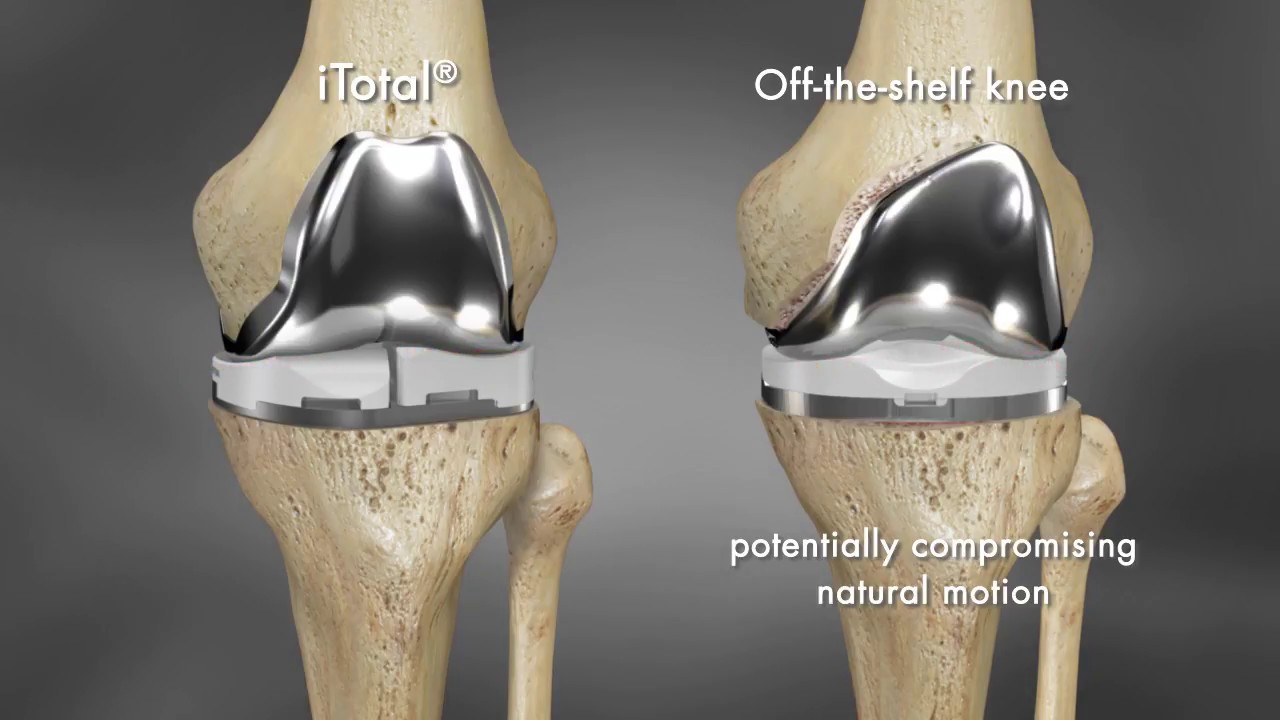 iTotal G2 iFit Animation (MK-02773-AD) - Florida Orthopaedic Institute ...