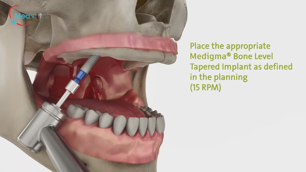 What is Dental Implant All on 4 Procedure? - How do we do this ...