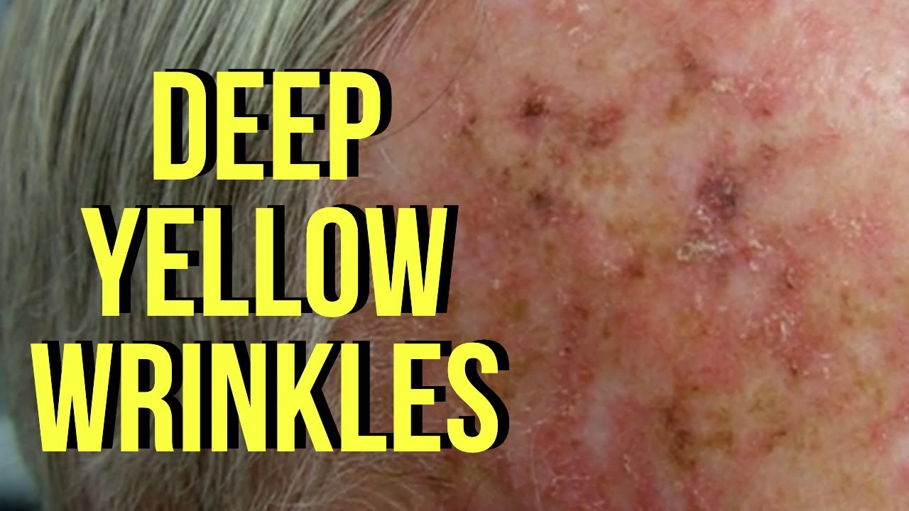What is Solar Elastosis? Yellow Damaged Skin | Aging Skin Wrinkles From ...
