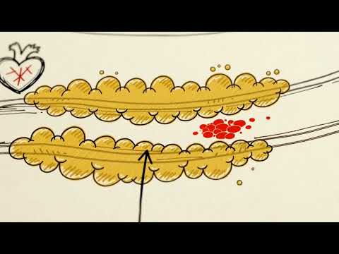 Heart Bypass Surgery | Explainer Video by Knowlify