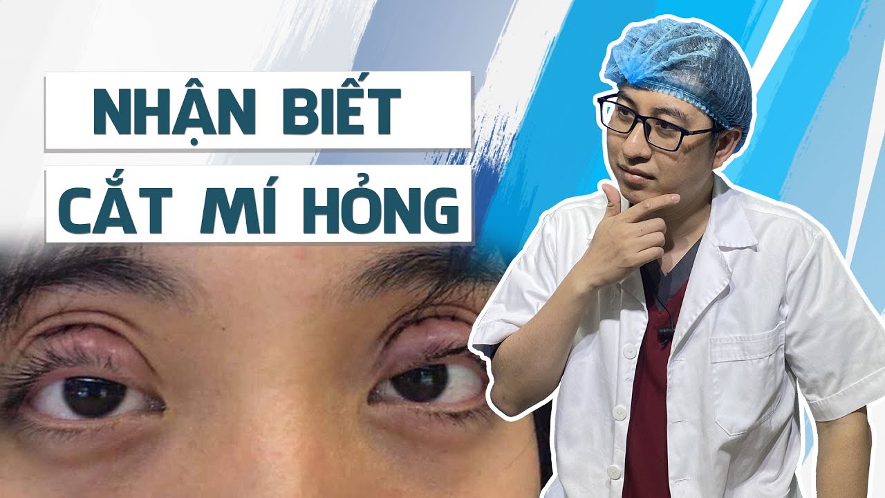 7 yếu tố nhận biết cắt mí mắt bị hỏng | Bs Mạnh - YouTube
