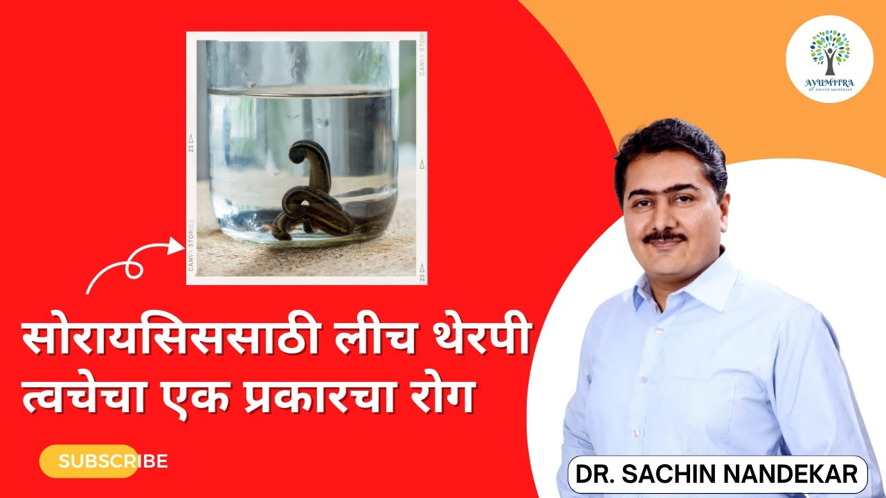 Leech therapy for Skin diseases । रक्तमोक्षण । जलौकावचरण । जळू | Leech ...