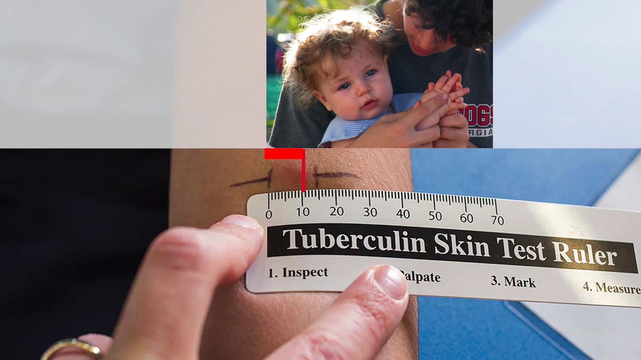 Diagnosing Latent TB Infection LTBI YouTube diagnosing-latent-tb-infection-ltbi-youtube
