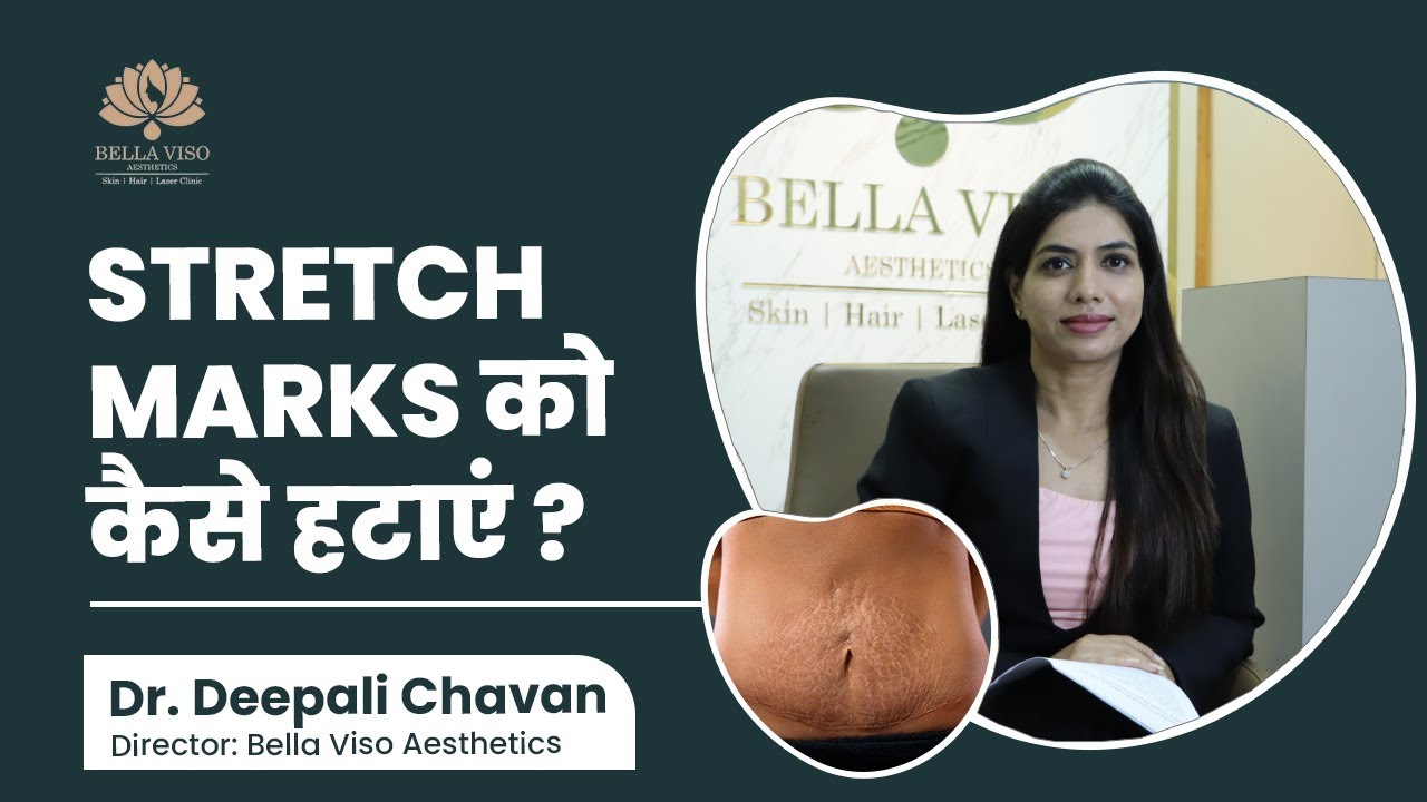 Stretch Marks को कैसे हटाएं ? | How to Remove Stretch Marks Permently ...