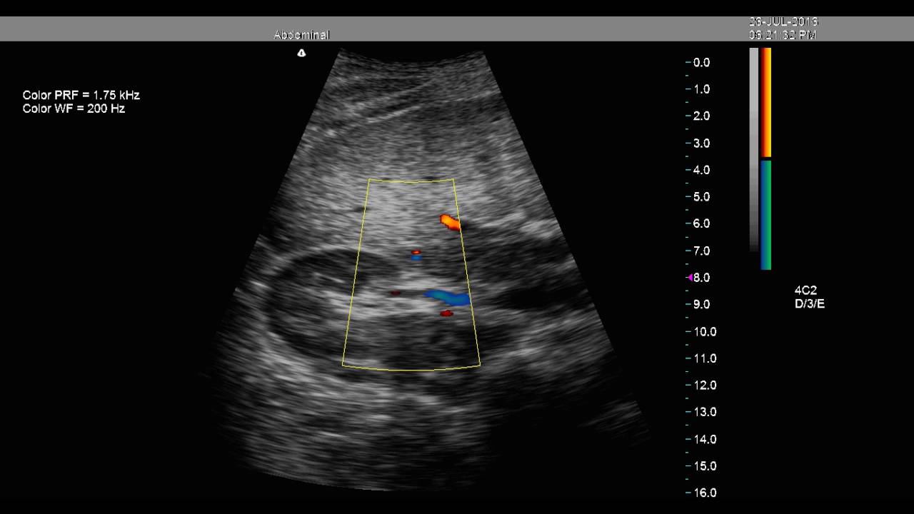 Rene destro, scansione trasversale passante per l'ilo. - YouTube