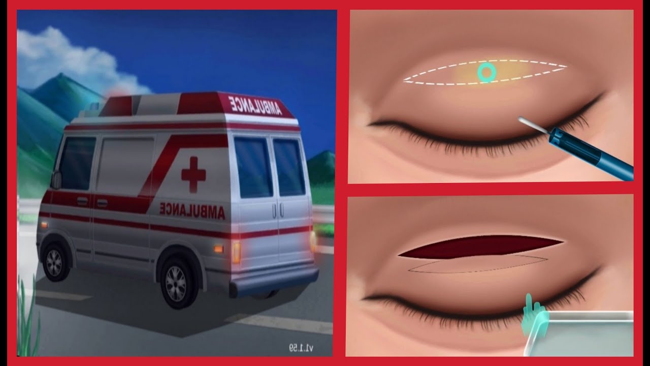 ASMR 👁️👁️ eye muscle surgery animation video - YouTube