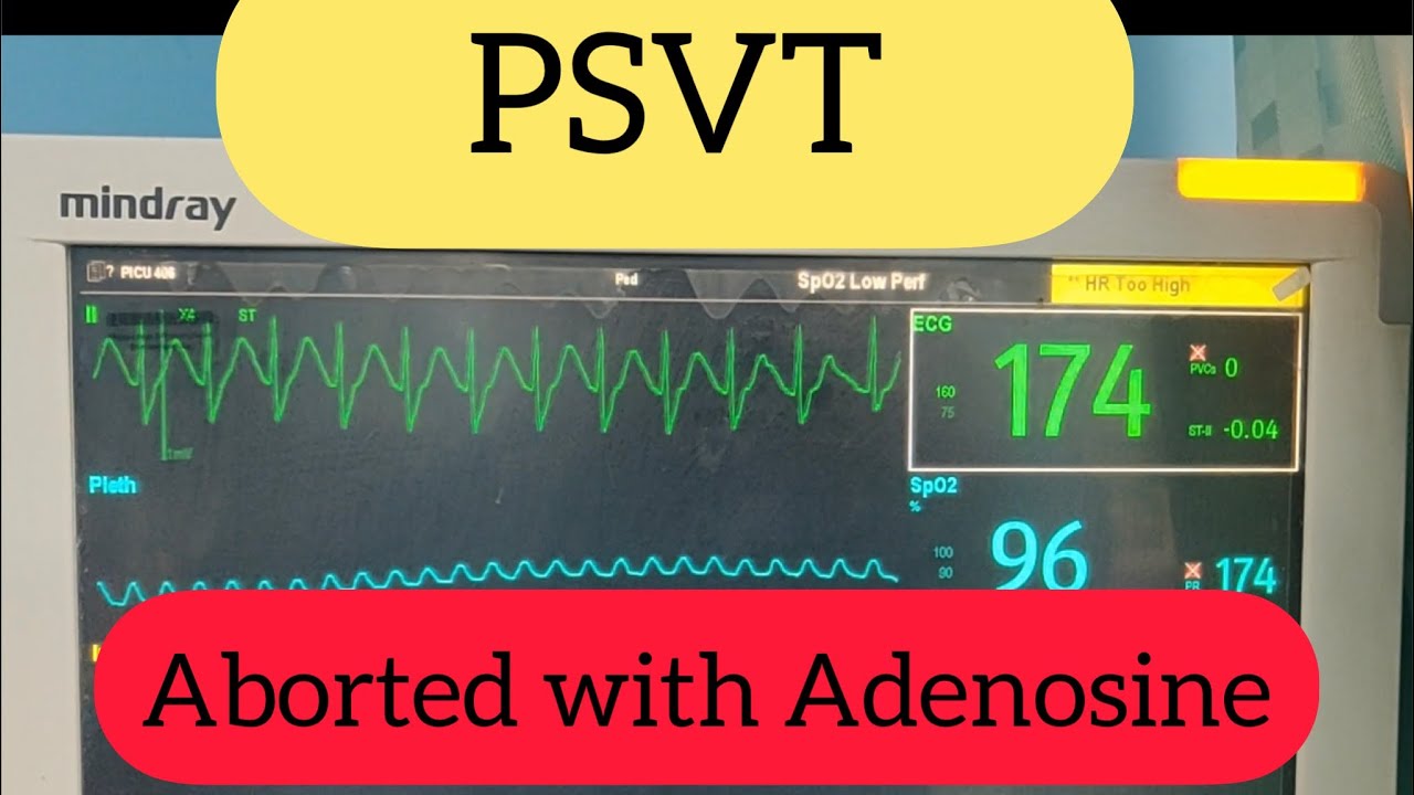 psvt reversal with adenosine | supraventricular tachycardia ...