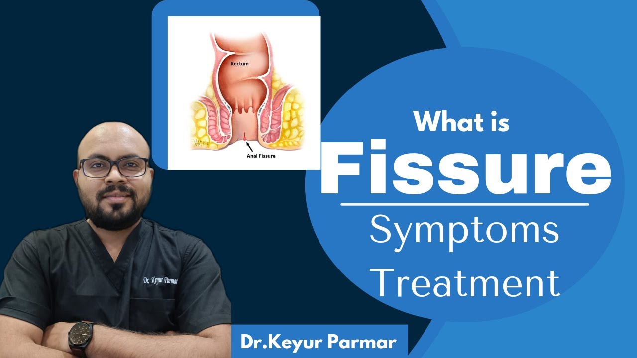 What is a Fissure A Friendly Explanation
