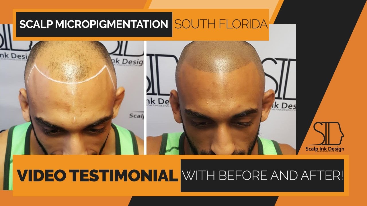 Scalp Micropigmentation in Miami (SMP) - Asim's amazing results with ...