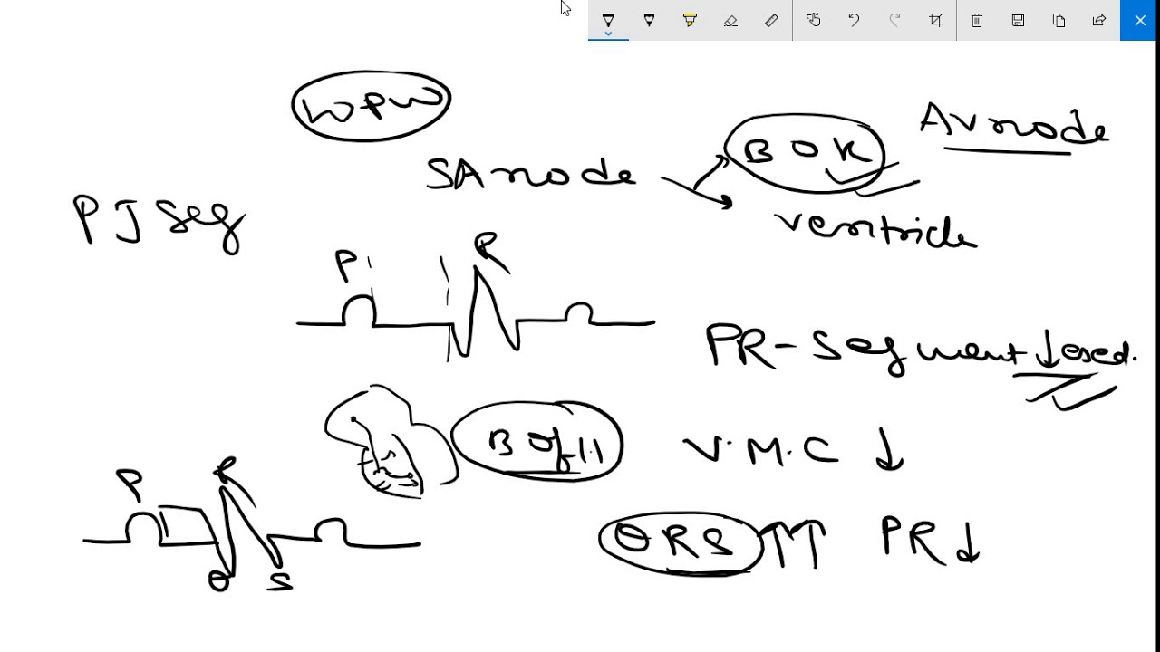ACCELERATED AV CONDUCTION[ LOWN GANONG SYNDROME , WOLFF PARKINSON ...