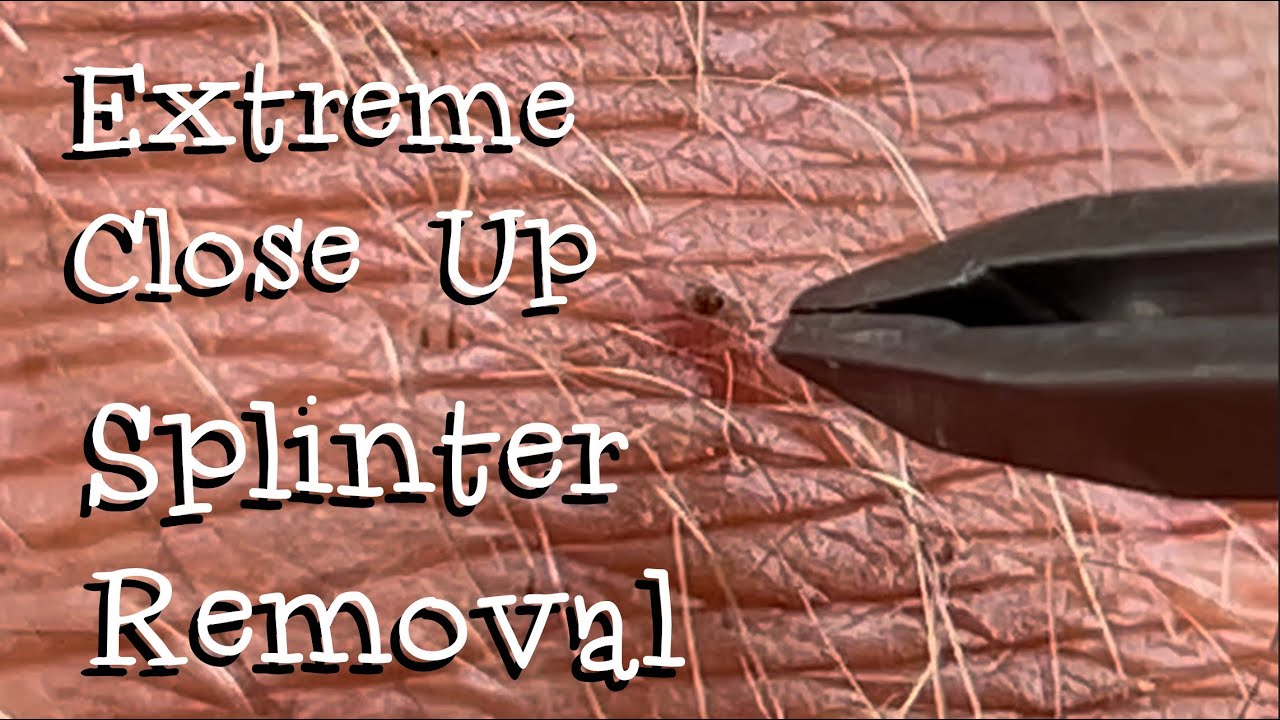 Splinter Removal, Extreme Close Up - YouTube