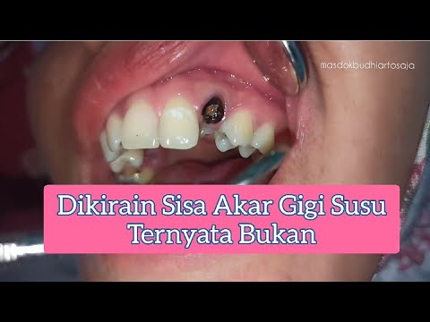 Setelah Dicabut Baru Ketahuan Kalau Sisa Akar Gigi Permanen - YouTube