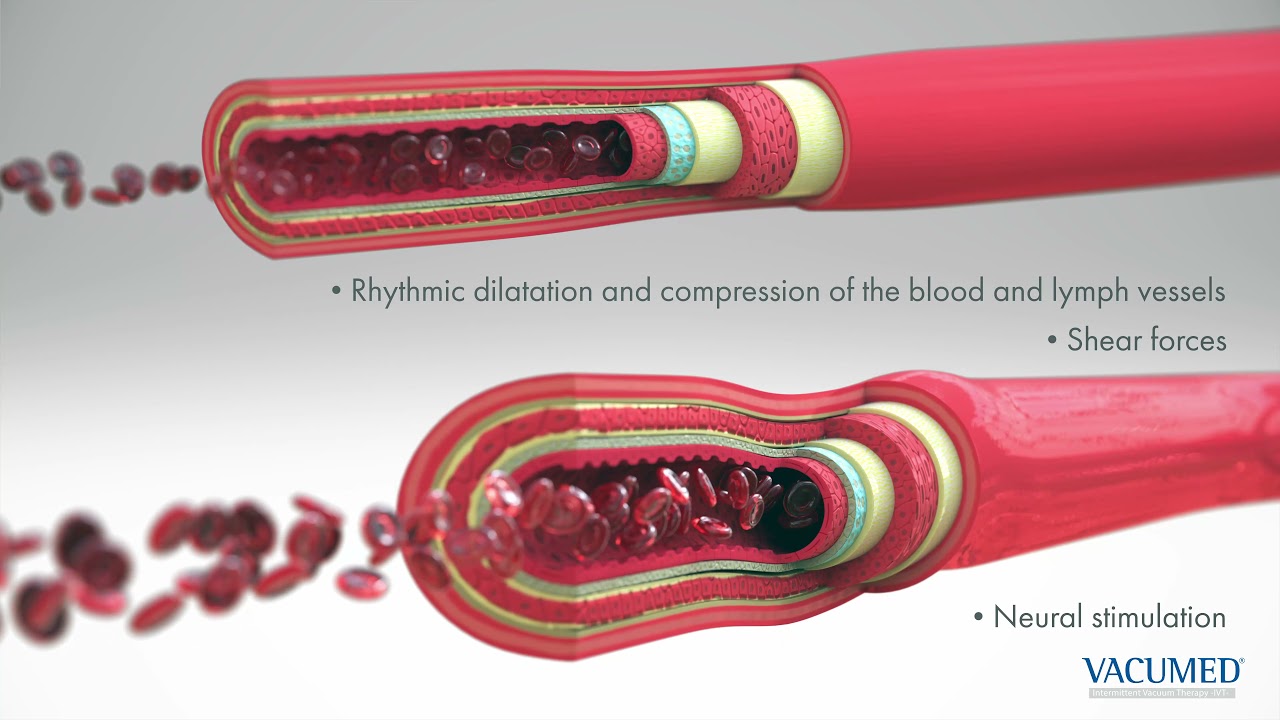 Vacumed in arterial diseases and diabetes - YouTube