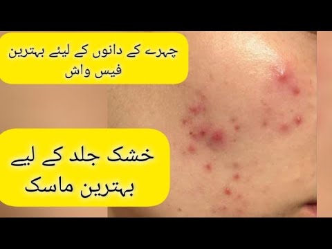 Acne Treatment at home | Chehray k daano ka best totka | Mask for dry ...