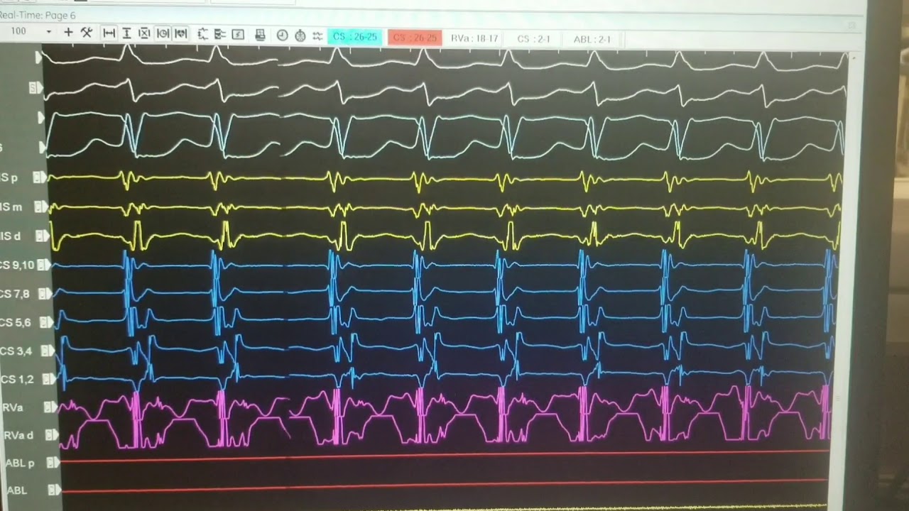 SVT differentiating AVNRT VS AVRT VS ATRIAL TACH - YouTube