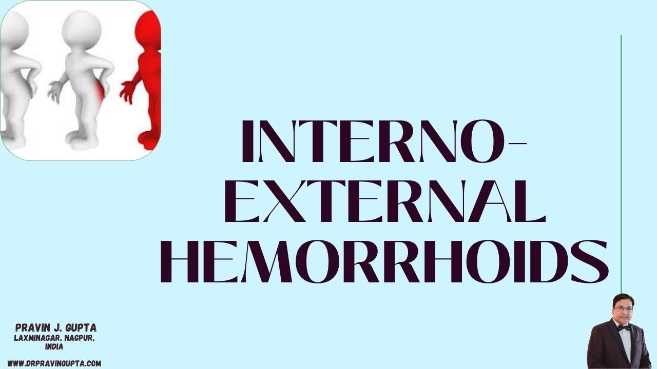 INTERNO-EXTERNAL HEMORRHOID SURGERY BY OUR TECHNIQUE - YouTube