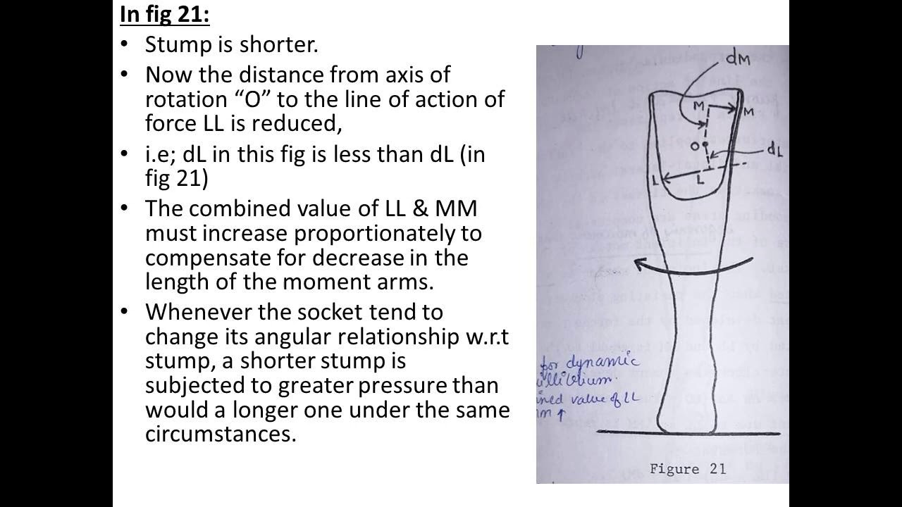 Llp 2 chap 8 cont.... biomechanics of BK prosthesis part 2 - YouTube