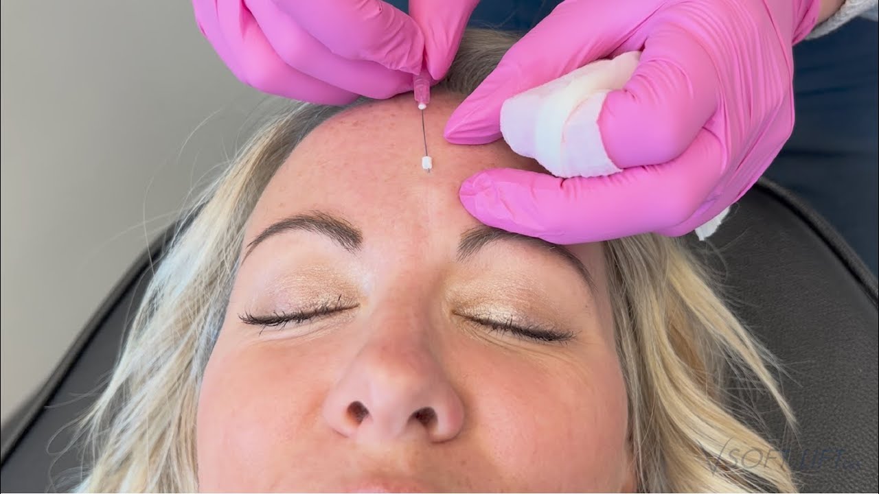 Remove Eleven Lines without Tox: VSoft Smooth Thread Treatment - YouTube