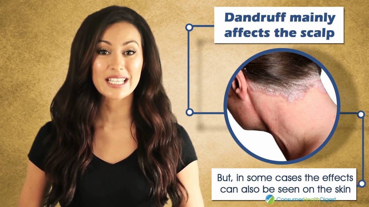 What is Dandruff and How to Get Rid of it Naturally? - YouTube