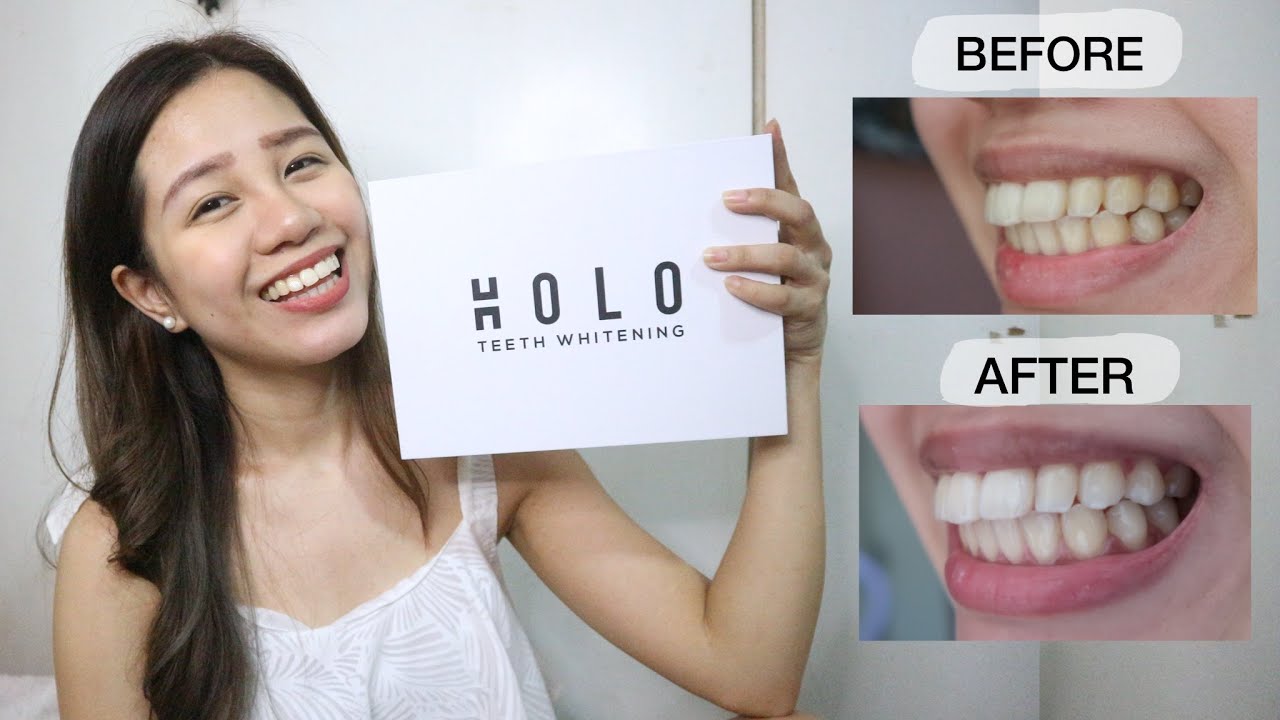trying HOLO Teeth Whitening Kit ph + honest thoughts and review | DOES ...