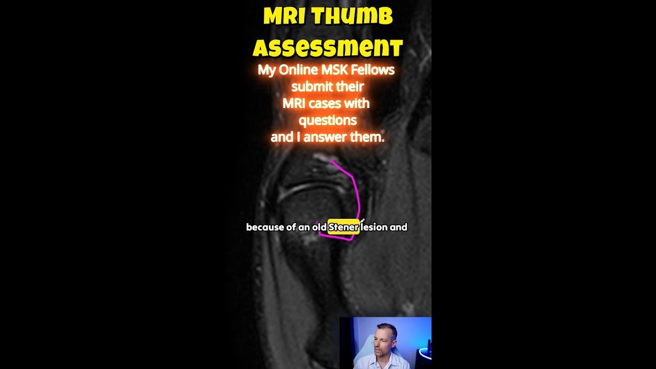 Finger MRI - volar plate analysis thumb - YouTube