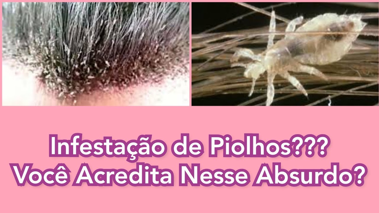 Piolhos? Eliminação de Piolhos e Lêndeas | Como Acabar com Piolhos e ...