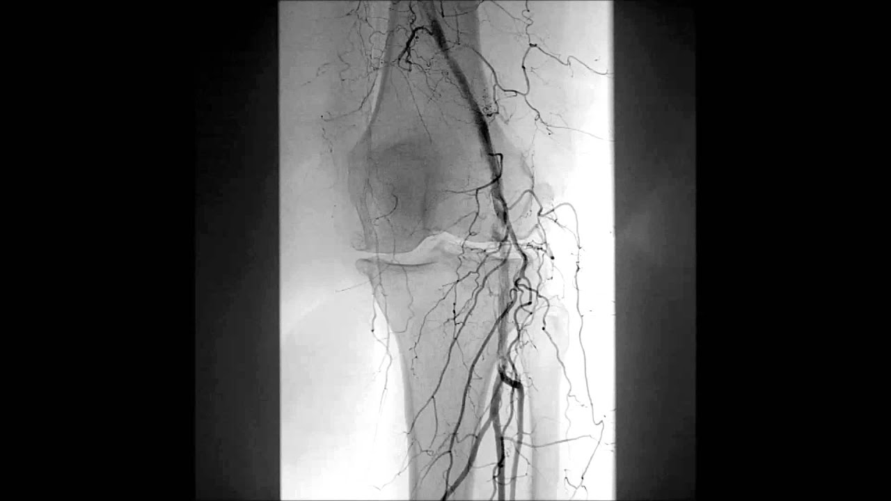 BTK balloon angioplasty Turbohawk Atherectomy - YouTube