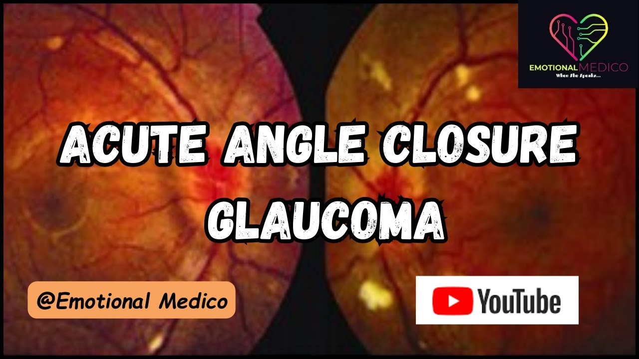 Acute Angle Closure Glaucoma | Pathogenesis | Eye - YouTube