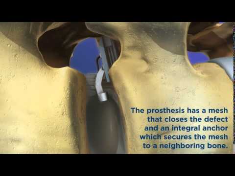 Network Medical Barricaid® Spine Disc Annular Closure - YouTube
