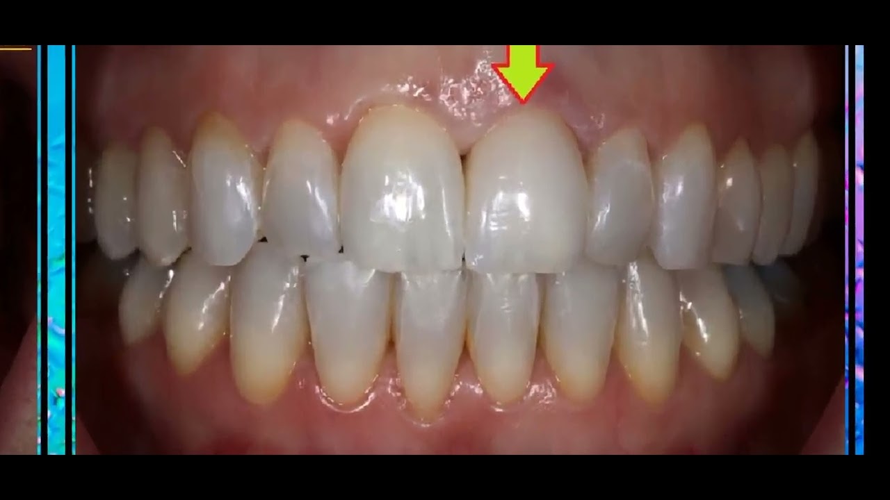 30- DISCOLORED ANTERIOR TOOTH/DISCOLORED FRONT TOOTH - YouTube