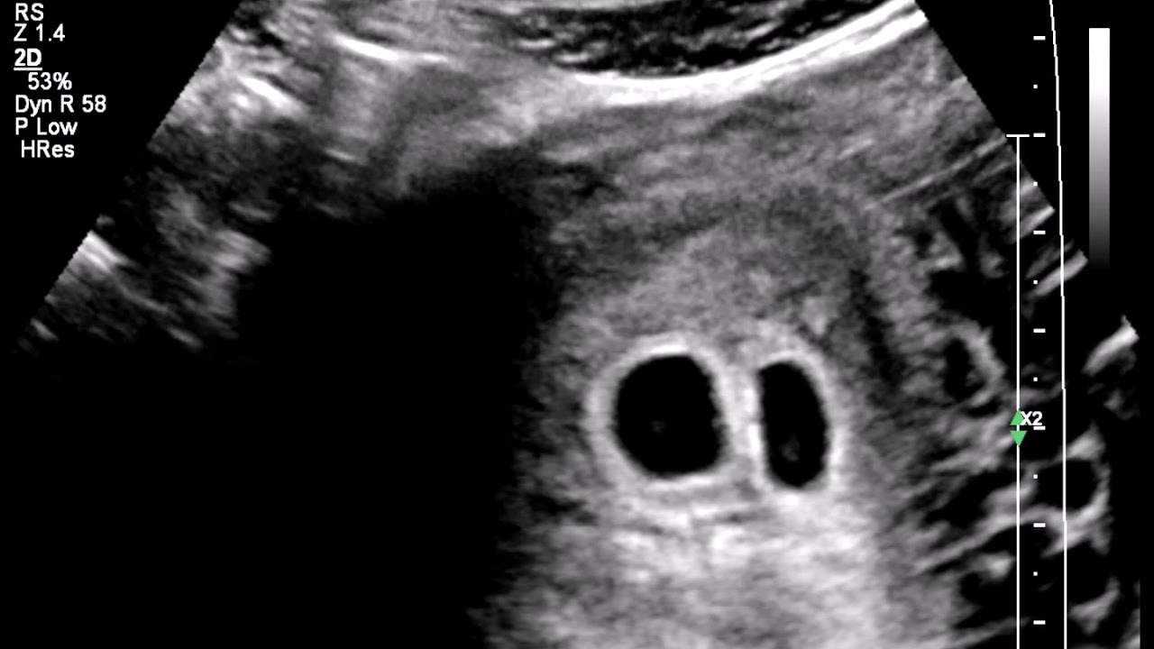 2D Pretecho Tweeling 5 Weken Zwanger - YouTube