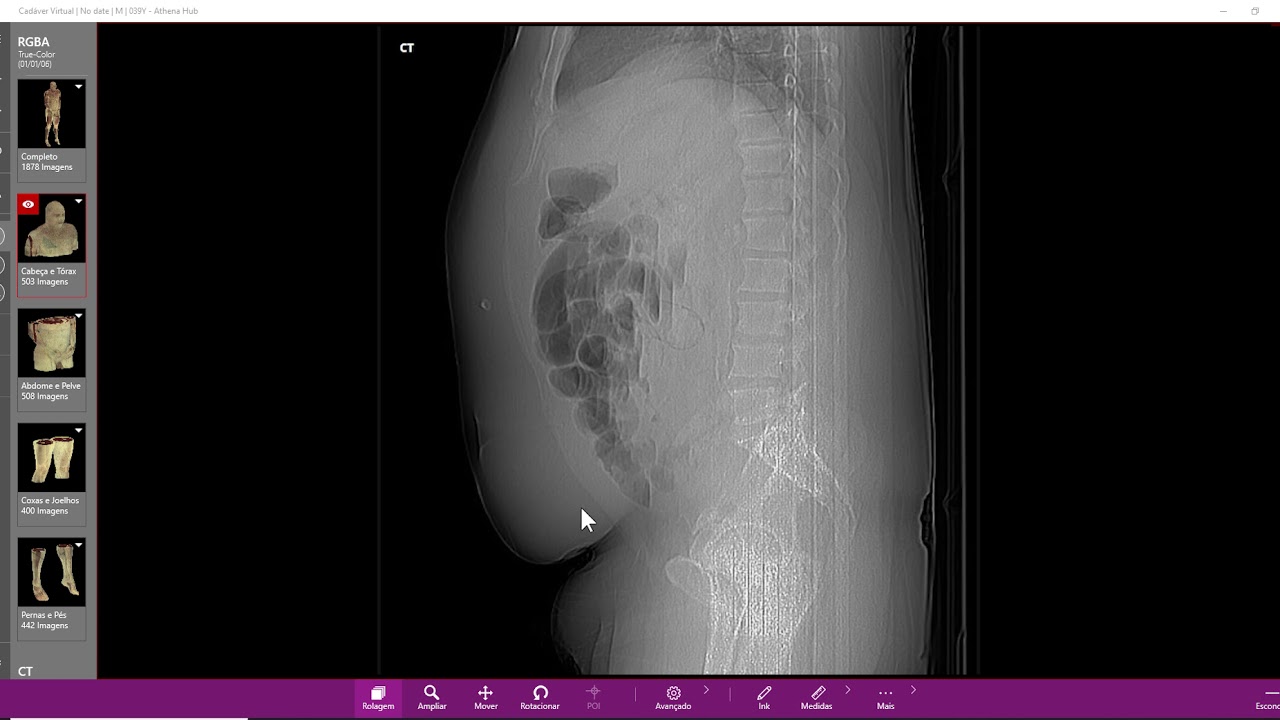 Infarto intestinal - YouTube