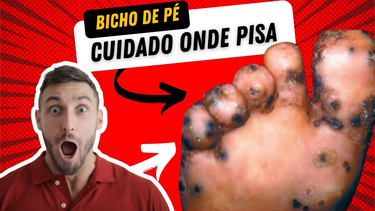 Bicho de Pé Tungíase Pulga nos Pés - CUIDADO ONDE PISA!! - YouTube