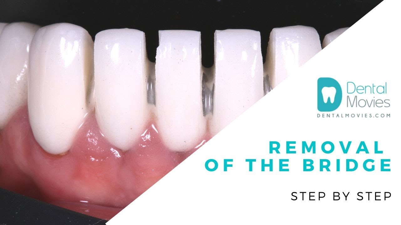 Removal of the bridge - step by step - dr B. Matejkowski 🦷 - YouTube