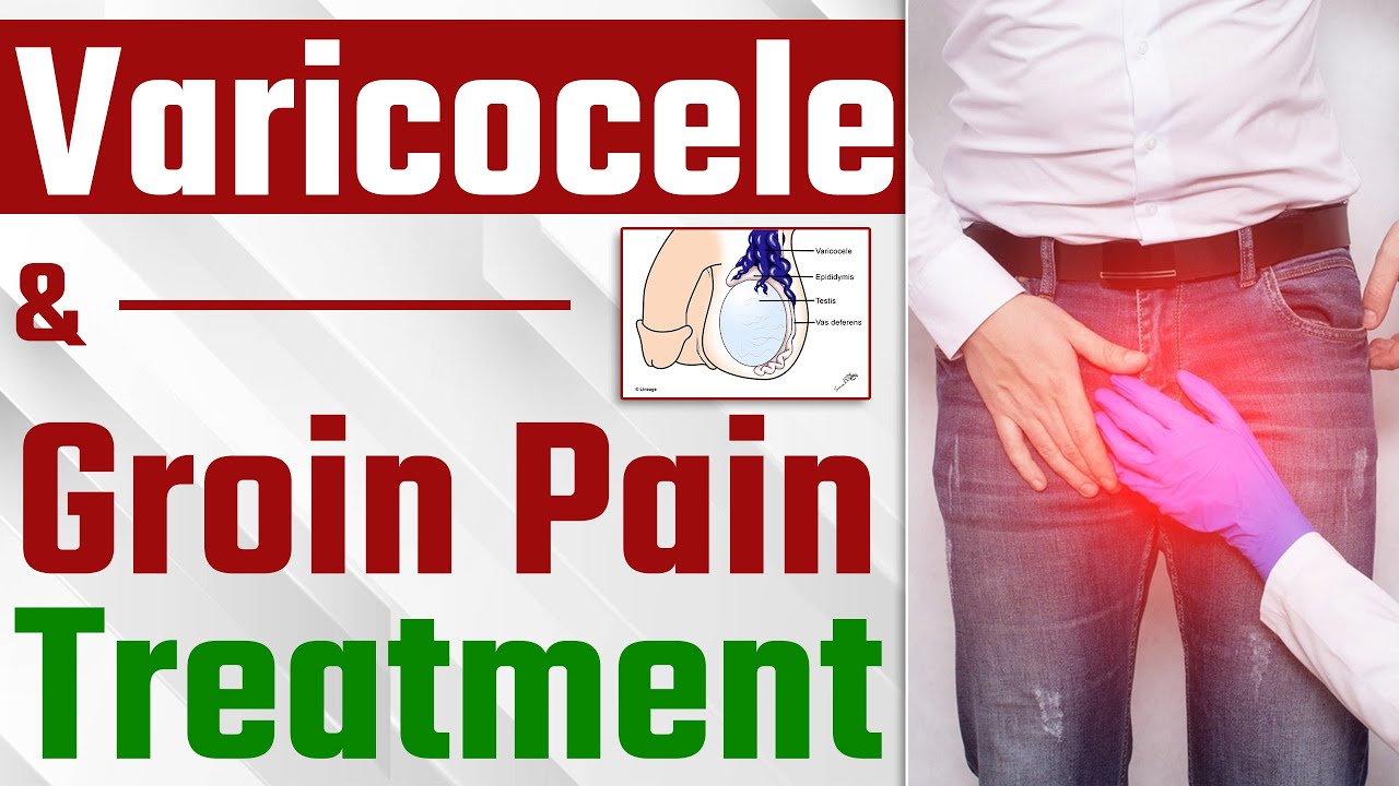 क्या वैरीकोसेल कारण है Groin Pain का | Varicocele & Groin Pain ...