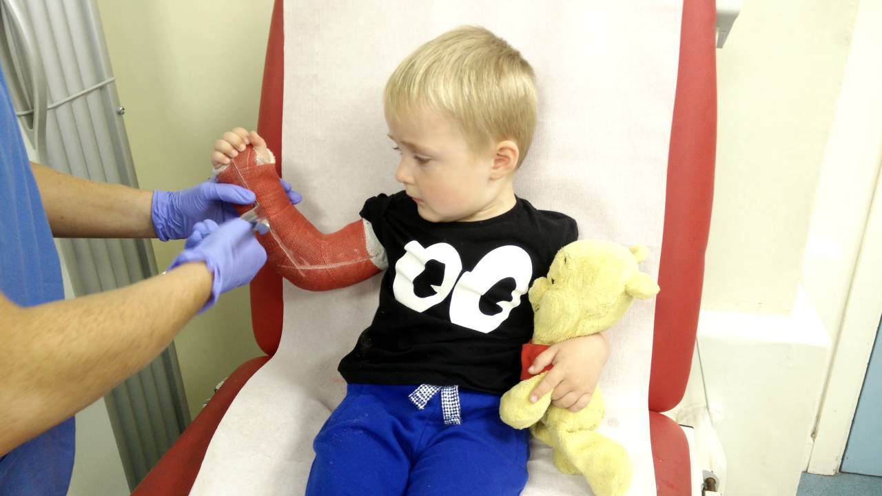 Removing cast - YouTube