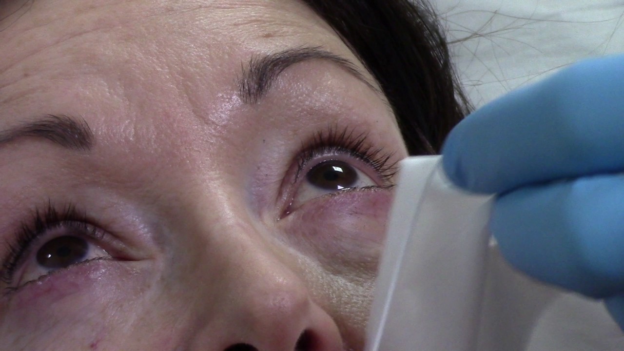 Blephex Blepharitis Treatment at Face & Eye - YouTube