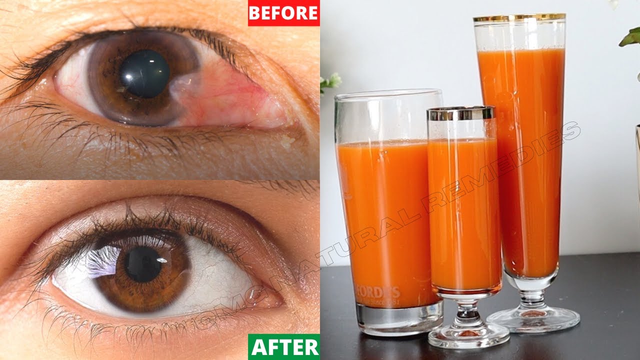 Avoid Surgery Get Rid Of Blurred Vision Get Stronger Vision Improve Eyesight Super Eye Treatment avoid-surgery-get-rid-of-blurred-vision-get-stronger-vision-improve-eyesight-super-eye-treatment