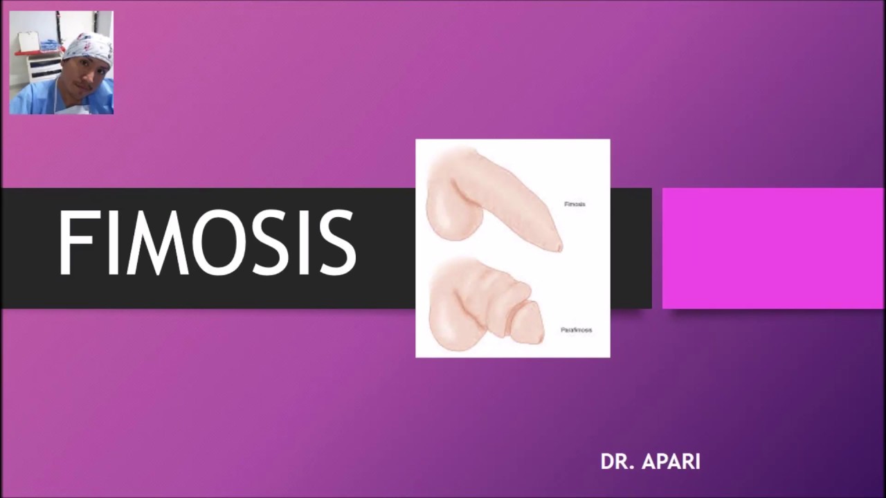 FIMOSIS EN NIÑOS - DR. APARI - YouTube