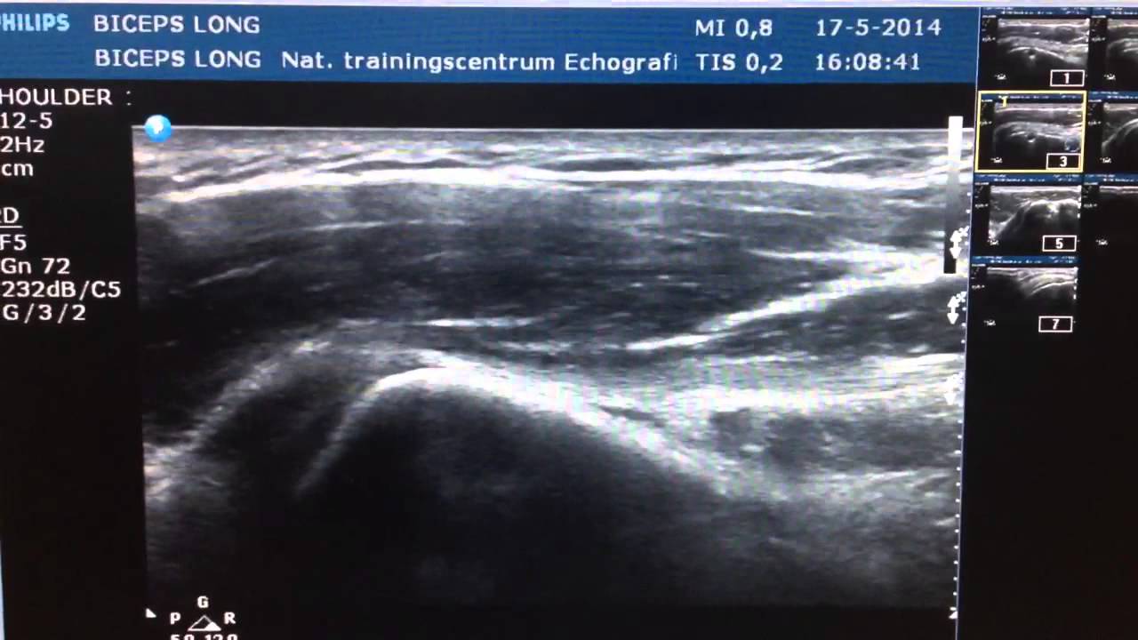 Ultrasound biceps bone cyst sulcus intertubercularis? - YouTube
