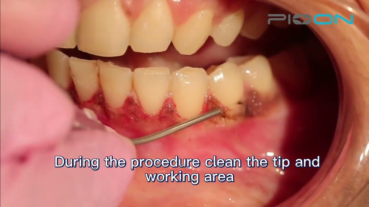 No bleeding and pain-free laser gingival depigmentation procedure ...