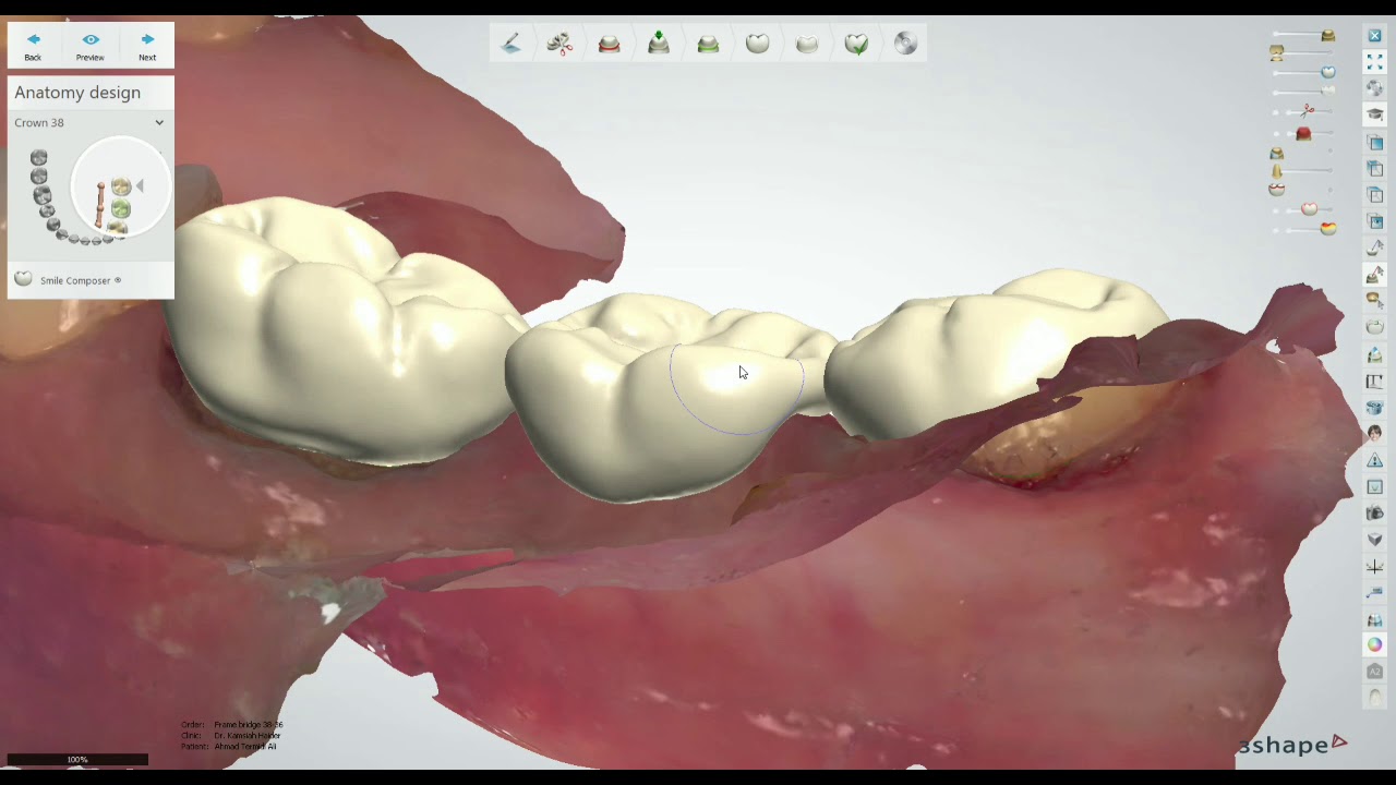 Bridge Zirconia Design on 3shape Dental System by Asia Afrika Dental ...