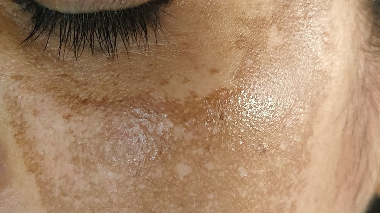 Melasma | Jhaiyan | Hyperpigmentation | melasma Treatment - YouTube